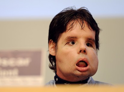 TheMorbidlyFascinatingPageFaceTransplants